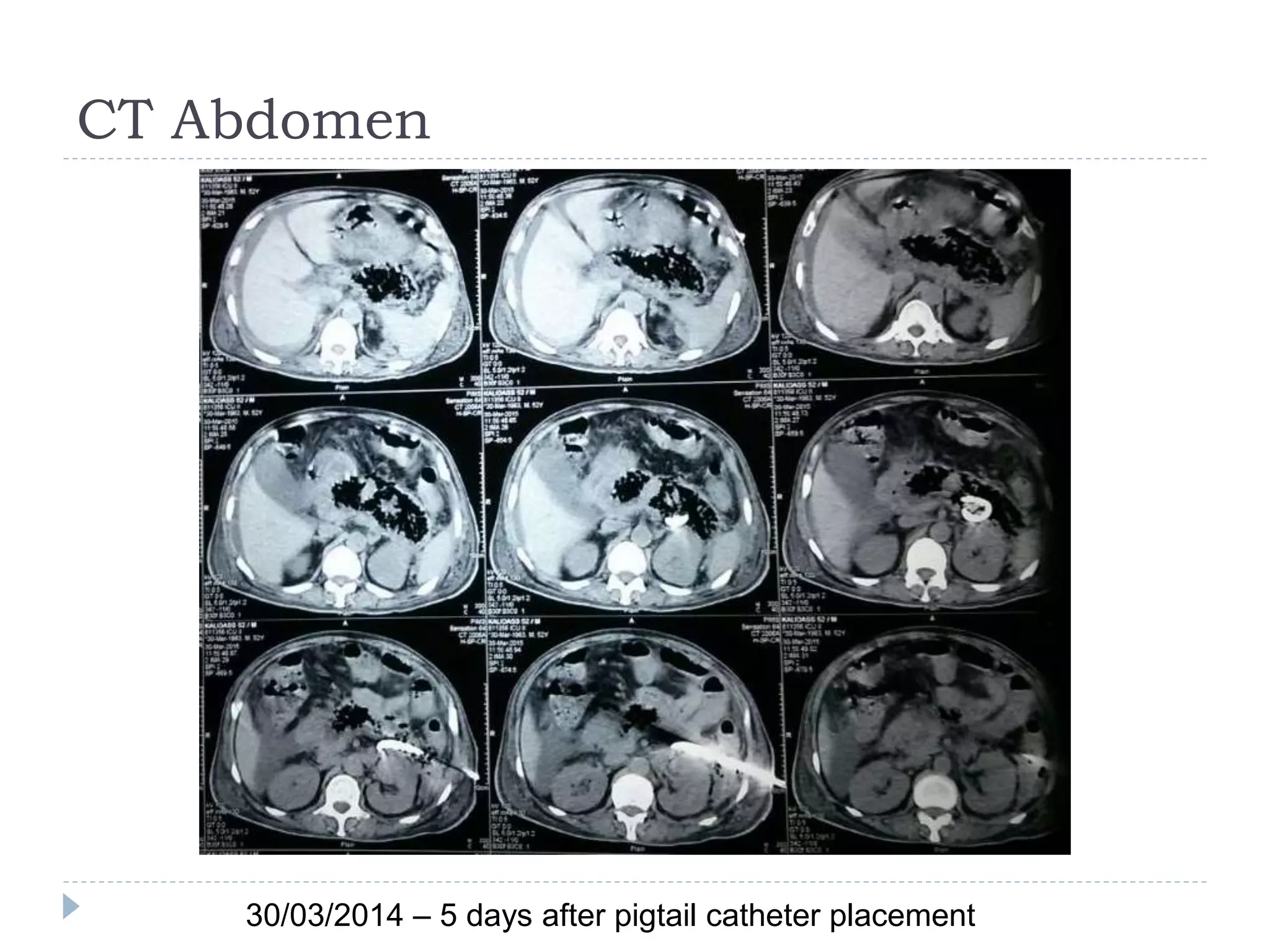 Necrotizing pancreatitis | PPTX