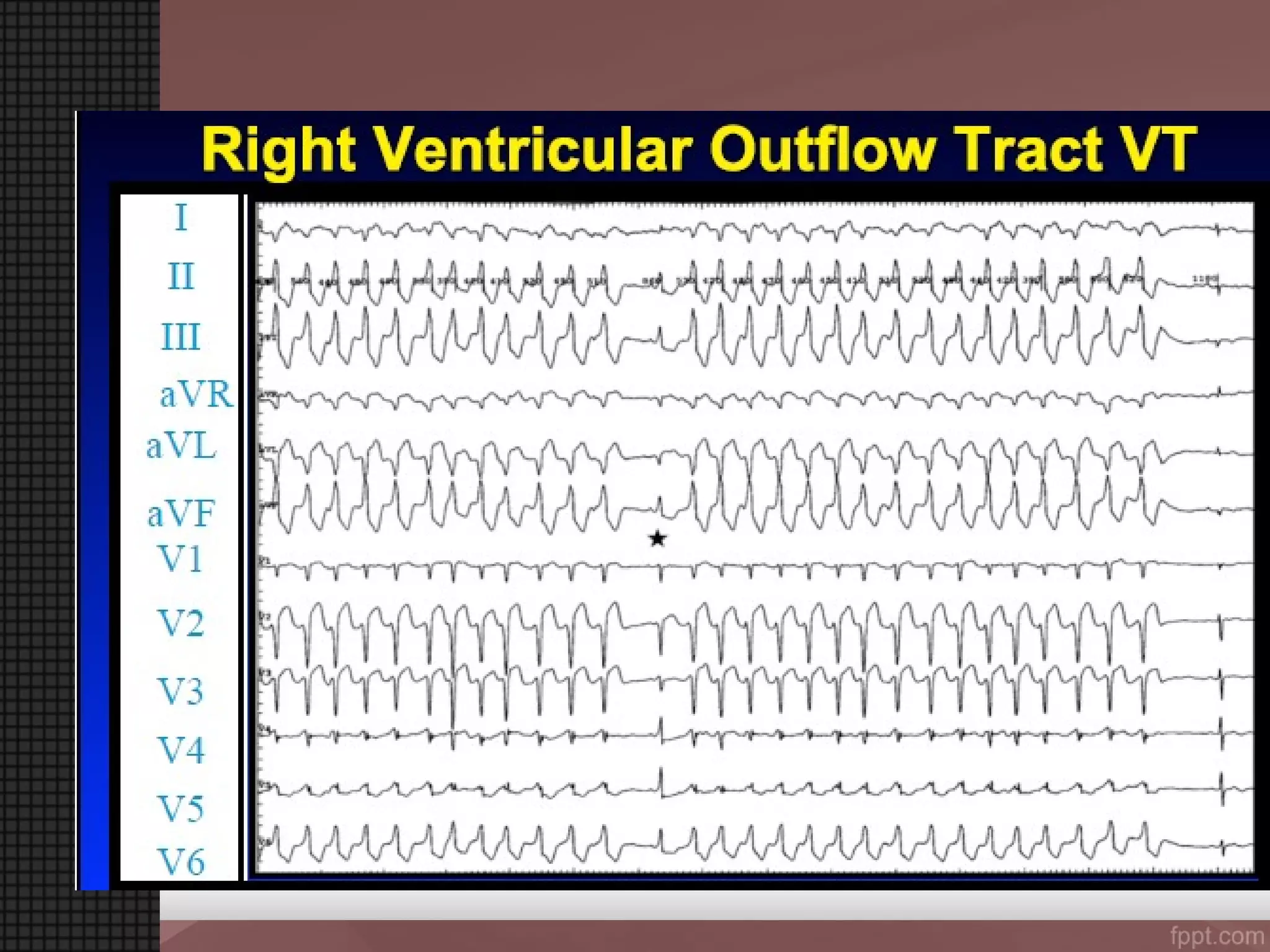 ventricular tachycardia (VT) Localisation | PPT