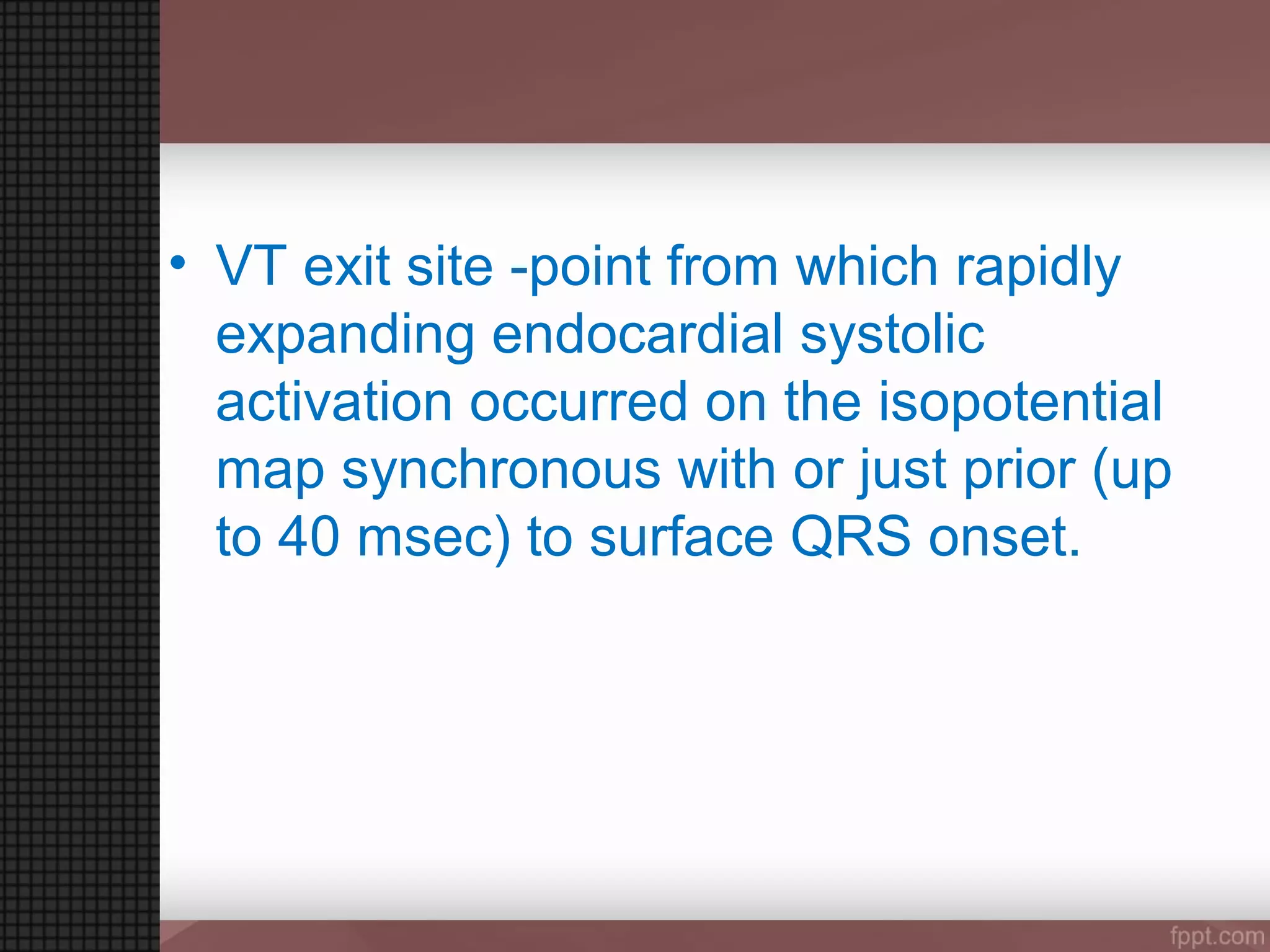 ventricular tachycardia (VT) Localisation | PPT