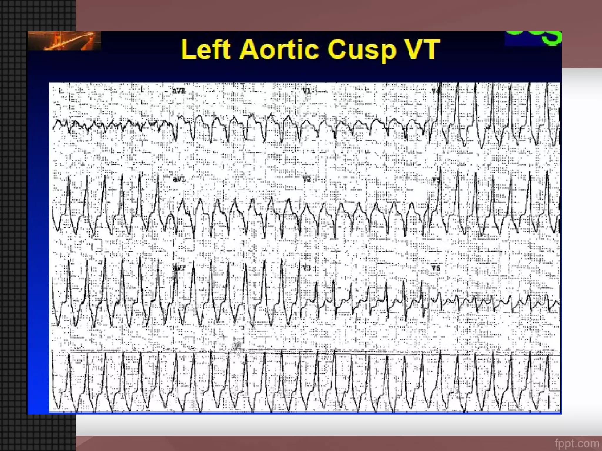 ventricular tachycardia (VT) Localisation | PPT