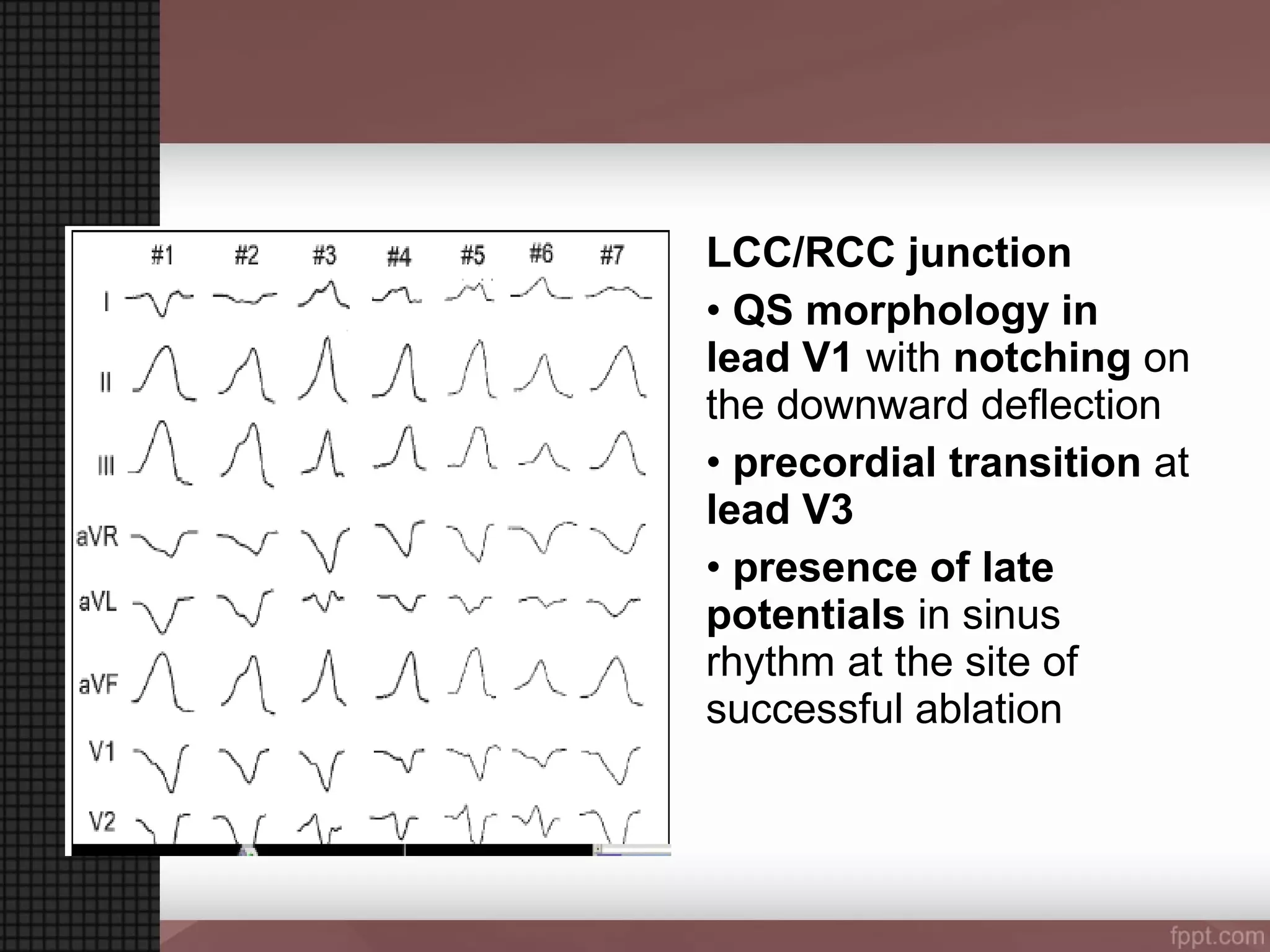 ventricular tachycardia (VT) Localisation | PPT