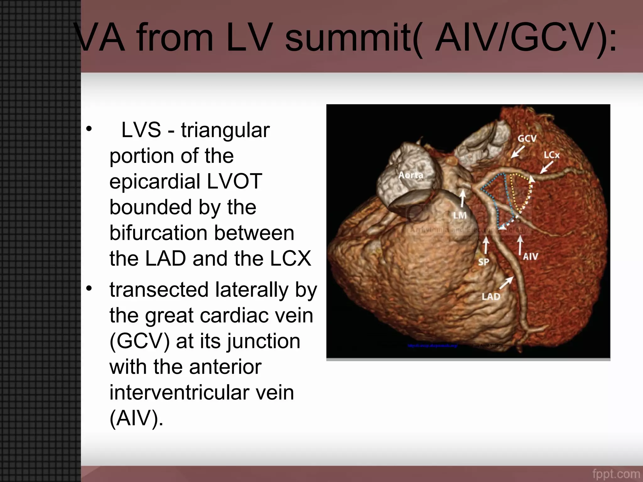 ventricular tachycardia (VT) Localisation | PPT