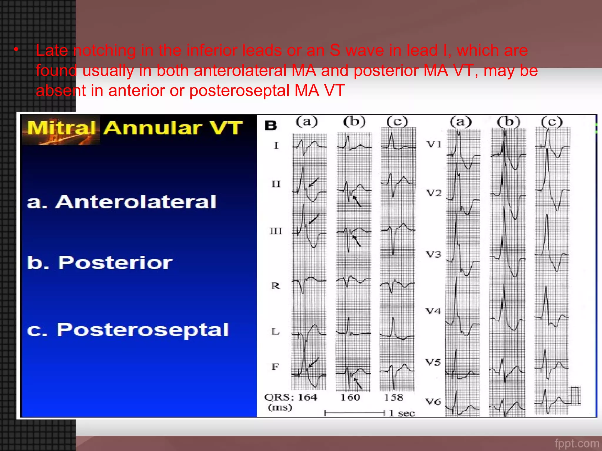 ventricular tachycardia (VT) Localisation | PPT