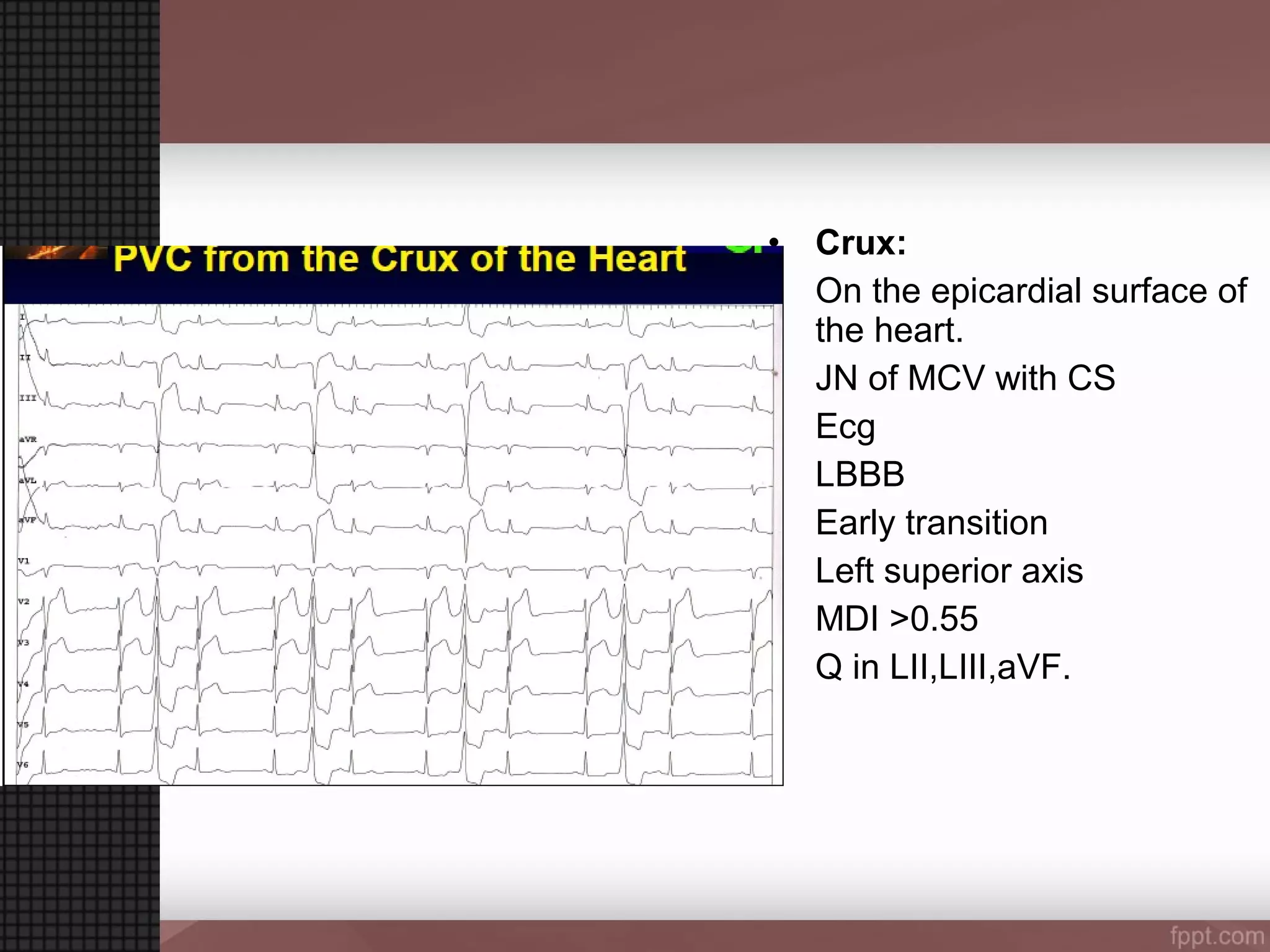 ventricular tachycardia (VT) Localisation | PPT