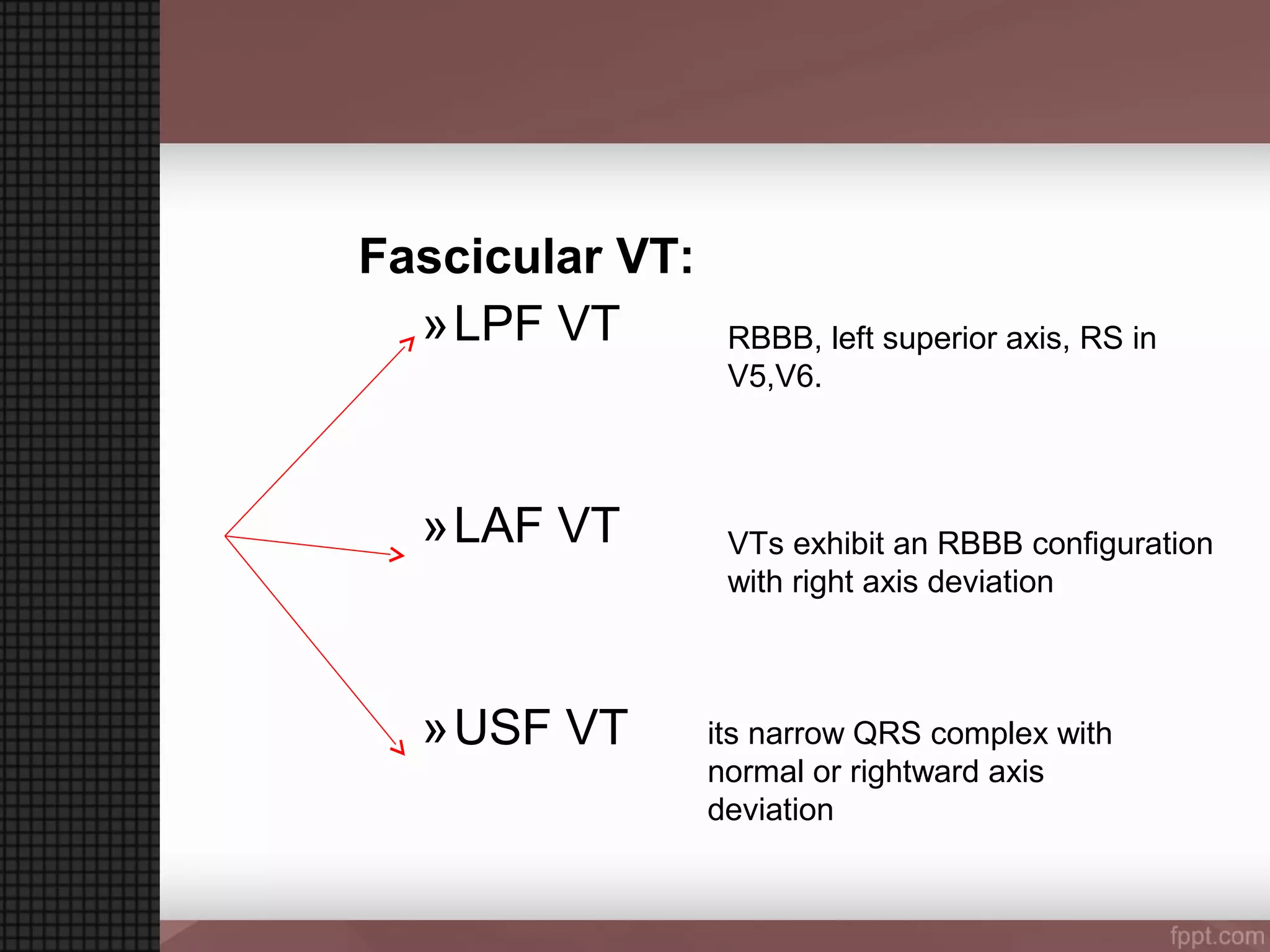 ventricular tachycardia (VT) Localisation | PPT