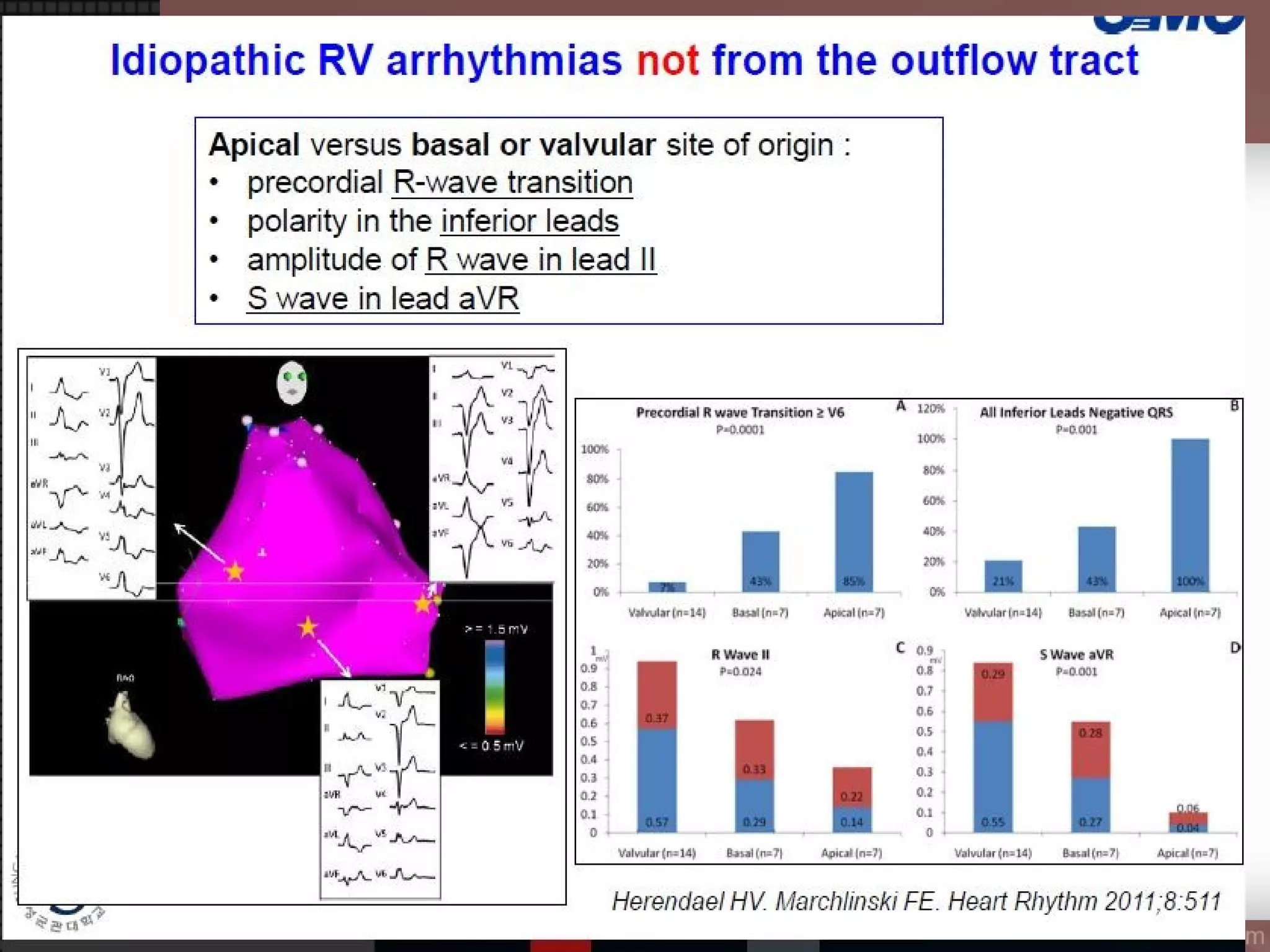 ventricular tachycardia (VT) Localisation | PPT