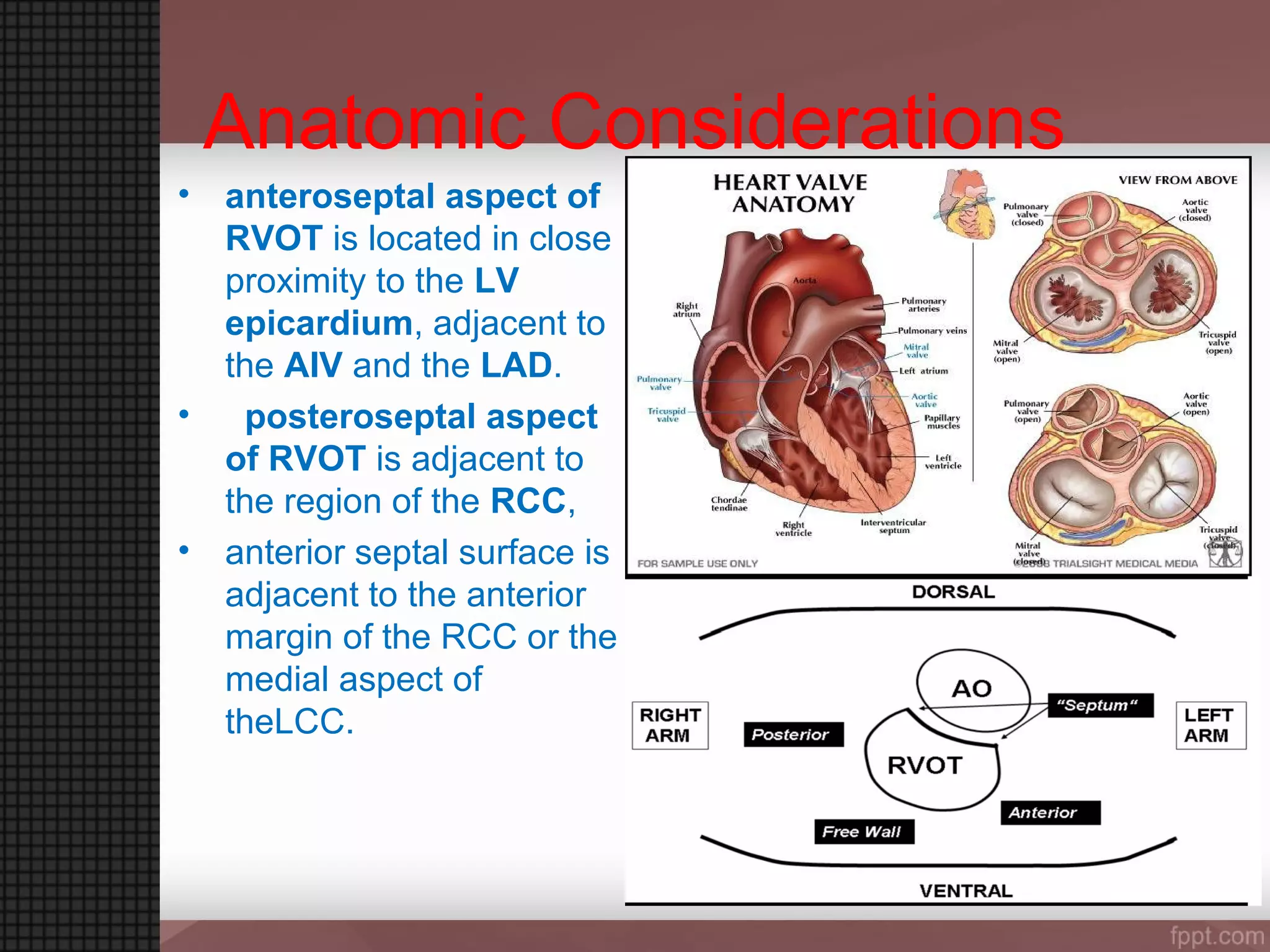 ventricular tachycardia (VT) Localisation | PPT