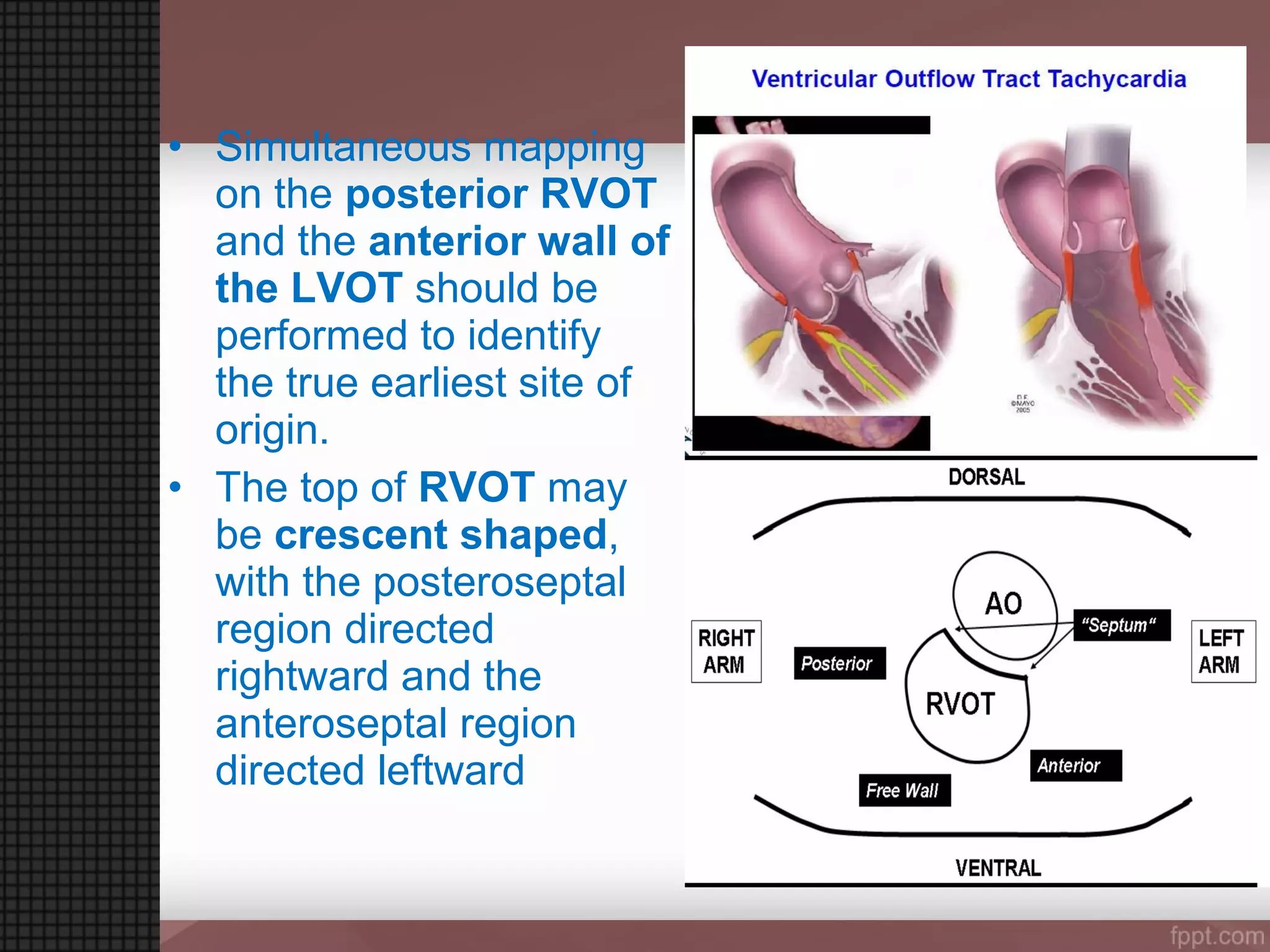 ventricular tachycardia (VT) Localisation | PPT