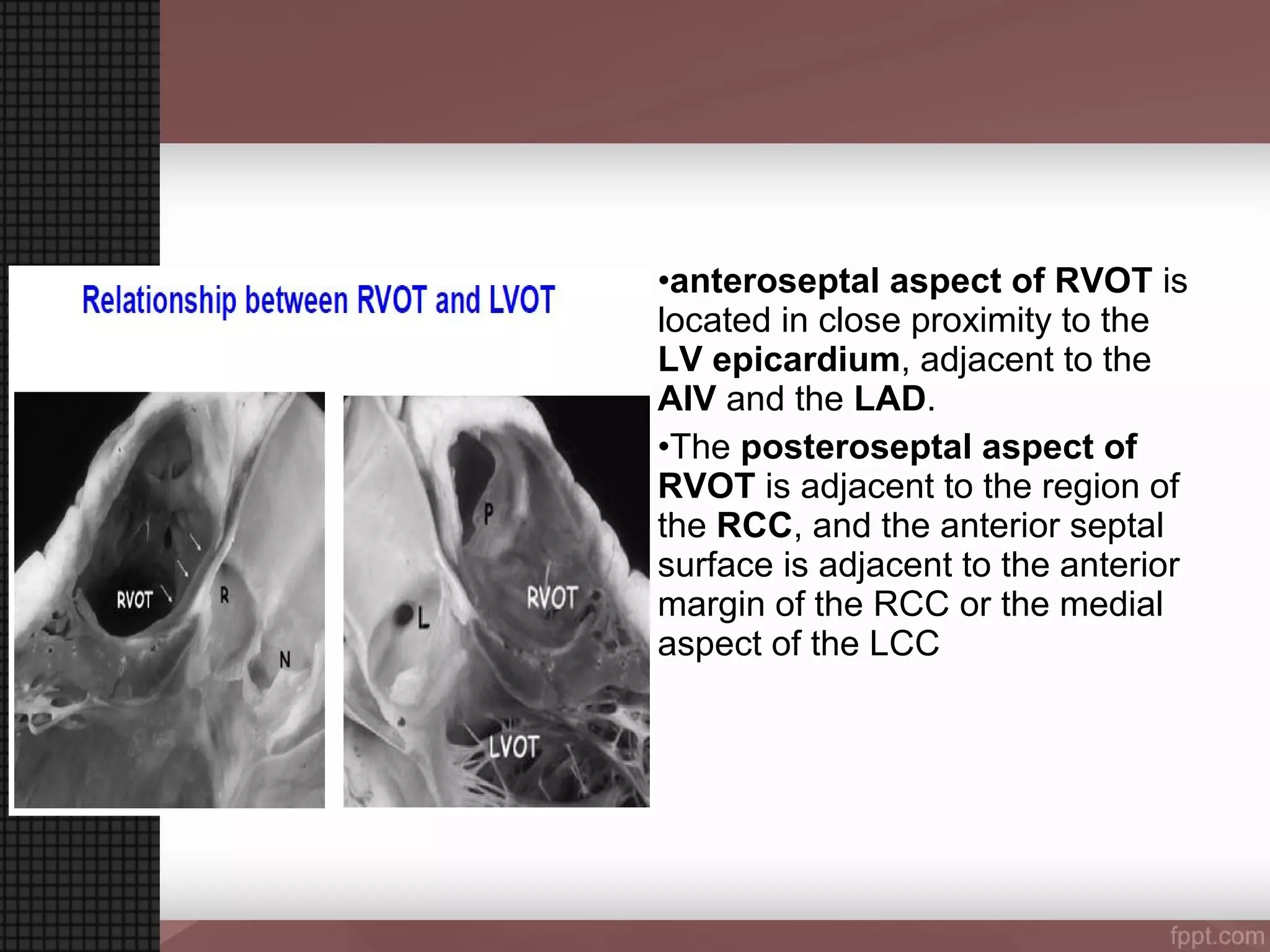 ventricular tachycardia (VT) Localisation | PPT