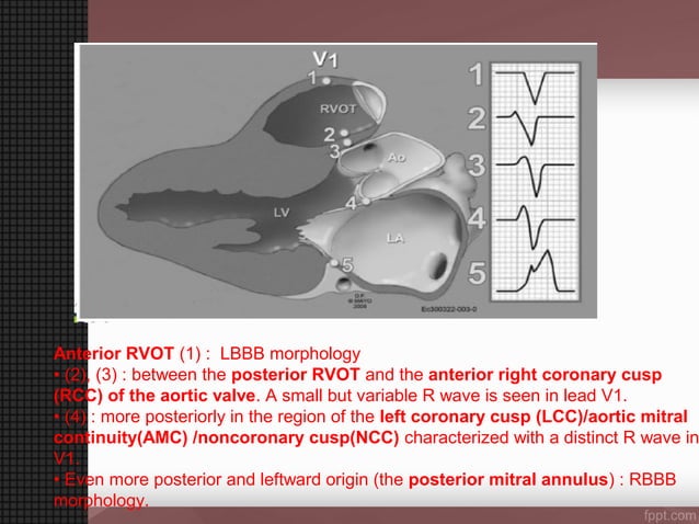 ventricular tachycardia (VT) Localisation | PPT