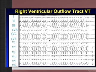 ventricular tachycardia (VT) Localisation | PPT