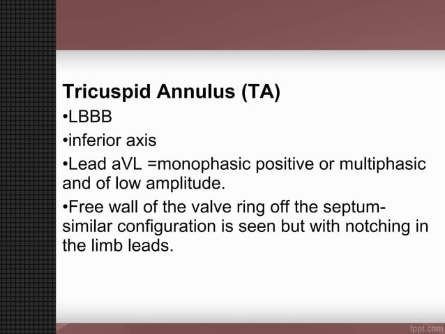 ventricular tachycardia (VT) Localisation | PPT