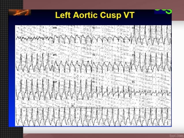 ventricular tachycardia (VT) Localisation | PPT