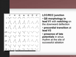 ventricular tachycardia (VT) Localisation | PPT