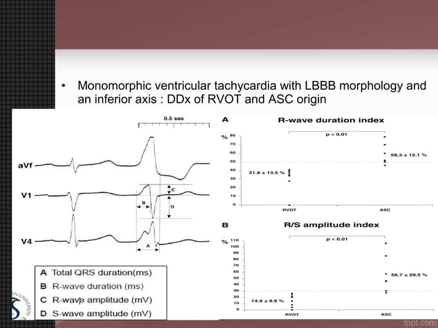 ventricular tachycardia (VT) Localisation | PPT