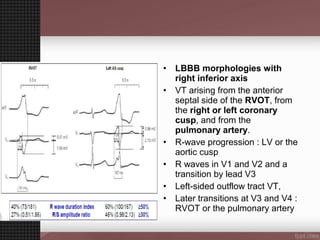 ventricular tachycardia (VT) Localisation | PPT