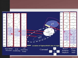 ventricular tachycardia (VT) Localisation | PPT
