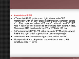 ventricular tachycardia (VT) Localisation | PPT