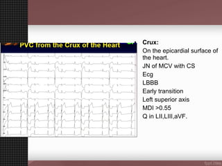 ventricular tachycardia (VT) Localisation | PPT