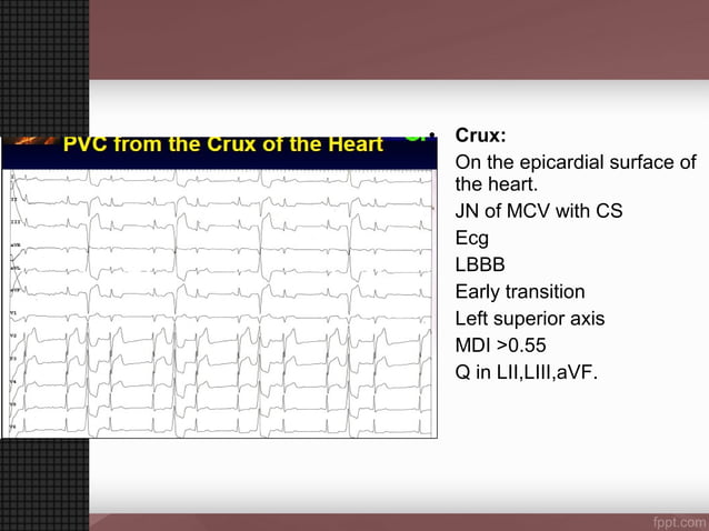 ventricular tachycardia (VT) Localisation | PPT