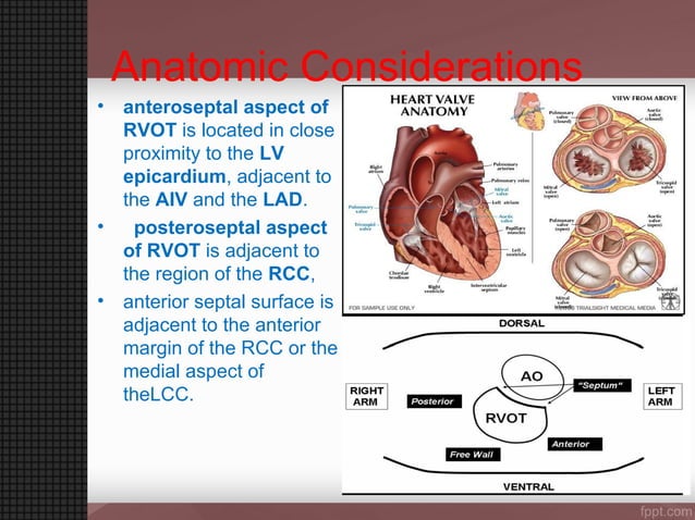 ventricular tachycardia (VT) Localisation | PPT