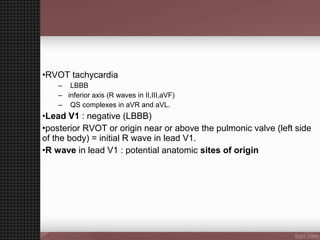 ventricular tachycardia (VT) Localisation | PPT