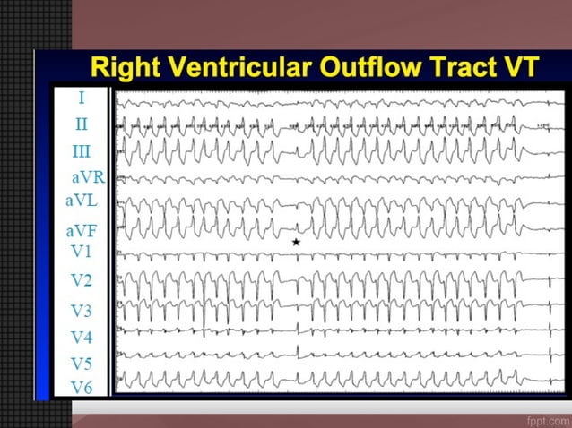 ventricular tachycardia (VT) Localisation | PPT