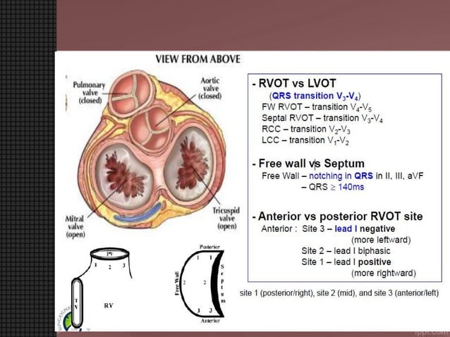 ventricular tachycardia (VT) Localisation | PPT