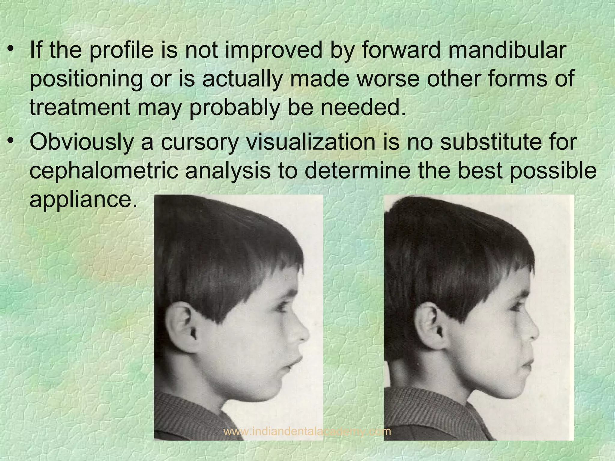 VTO (visualised Treatment objective) | PPT