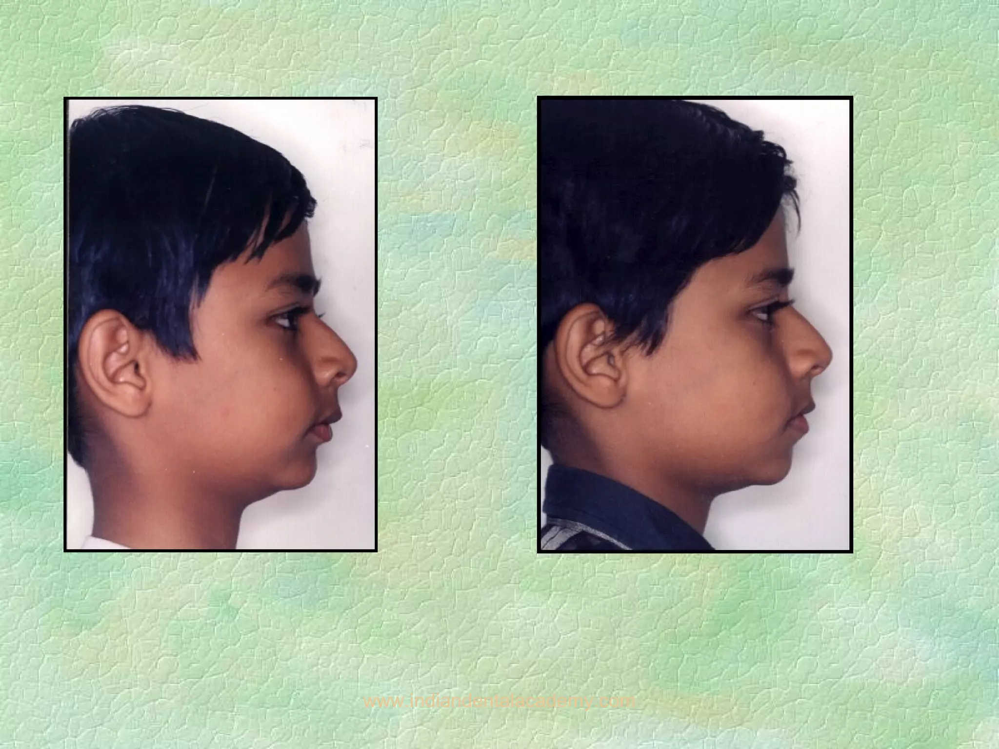 VTO (visualised Treatment objective) | PPT