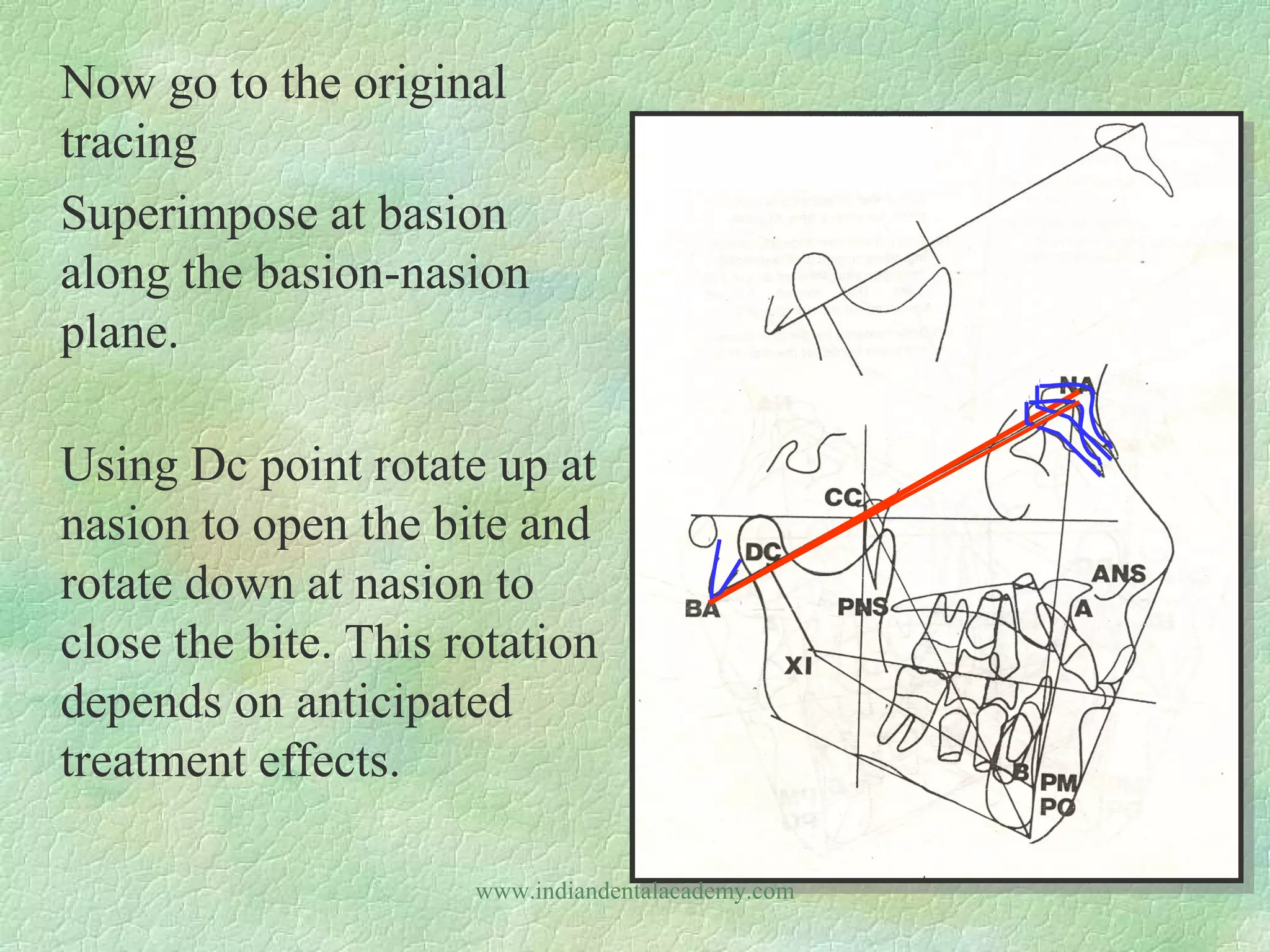 VTO (visualised Treatment objective) | PPT