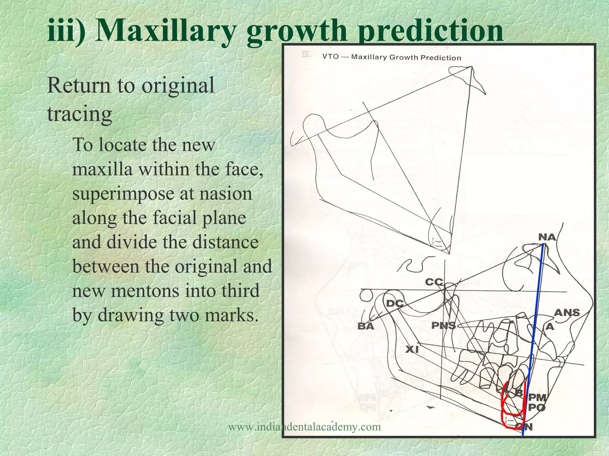 VTO (visualised Treatment objective) | PPT