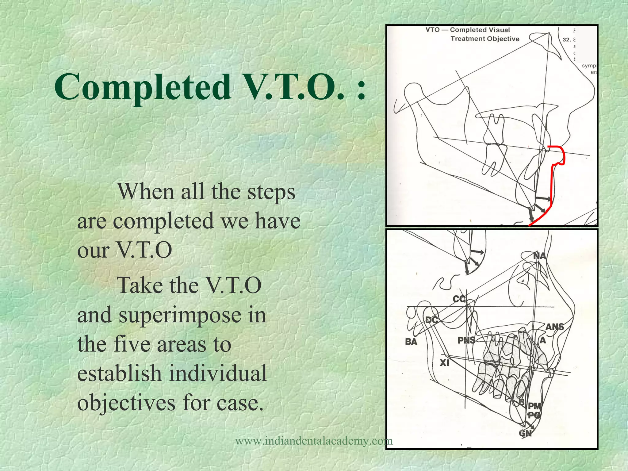 VTO (visualised Treatment objective) | PPT