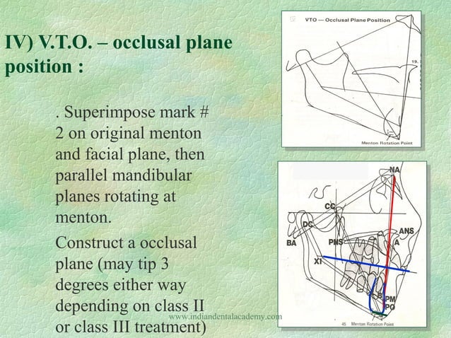 VTO (visualised Treatment objective) | PPT | Dental Health | Diseases ...