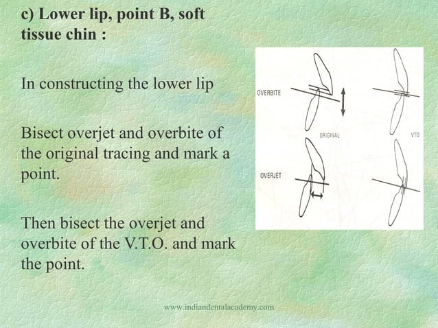 VTO (visualised Treatment objective) | PPT | Dental Health | Diseases ...