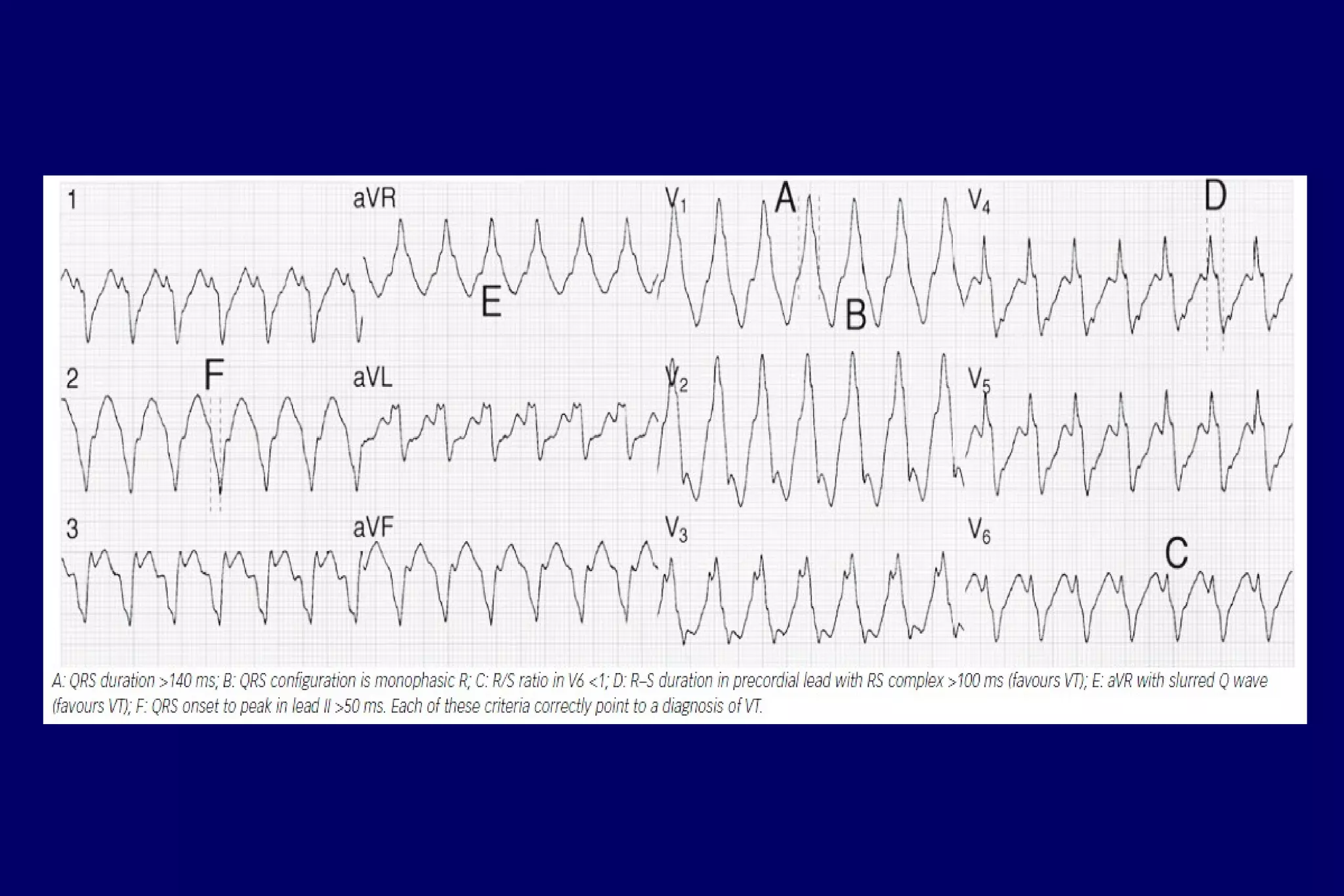 Vt vs svt ab copy | PPT