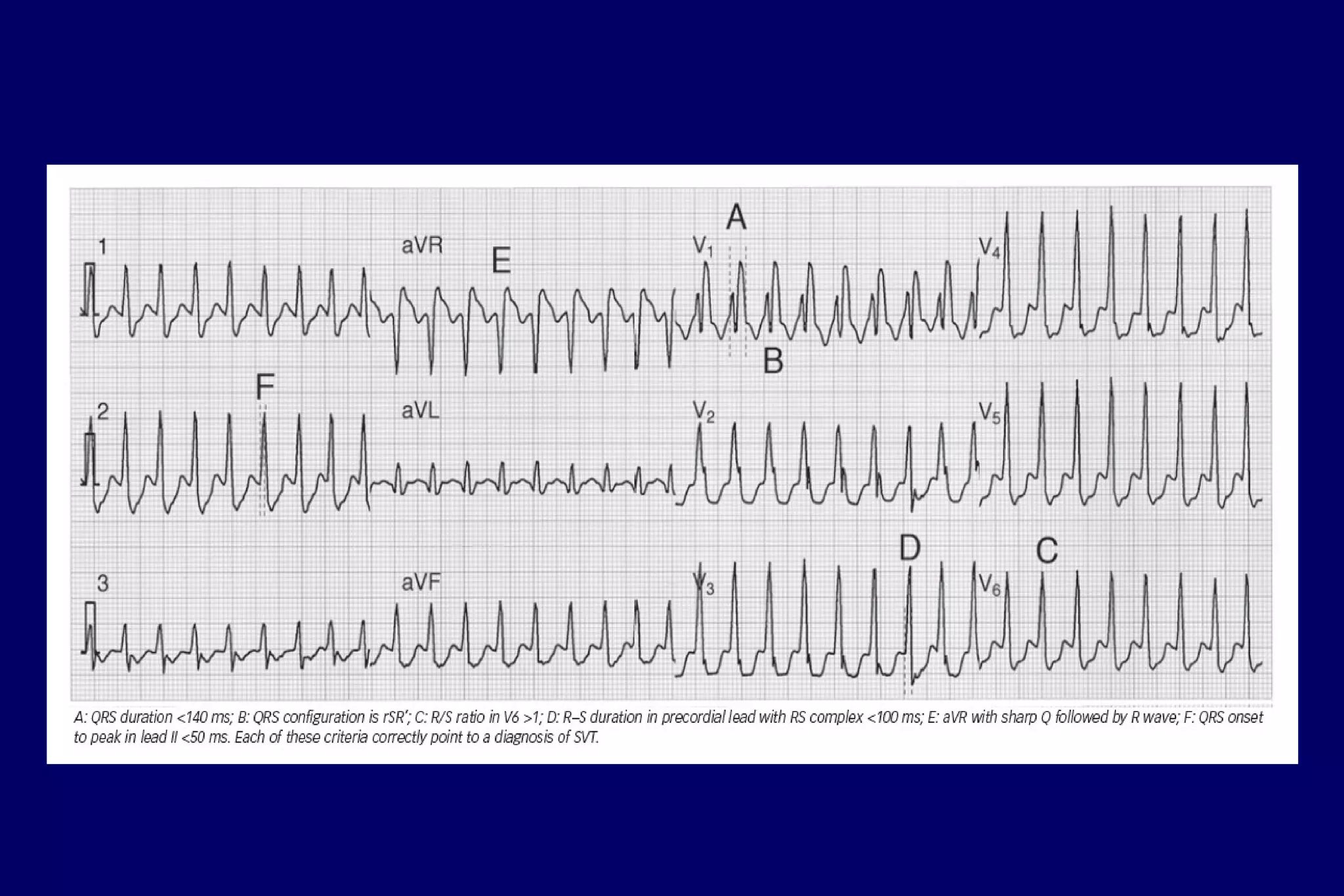 Vt vs svt ab copy | PPT