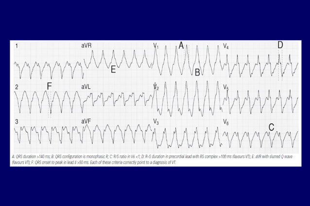 Vt vs svt ab copy | PPT | Heart and Cardiovascular Diseases | Diseases ...