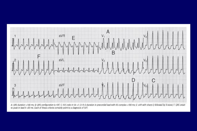 Vt vs svt ab copy | PPT | Heart and Cardiovascular Diseases | Diseases ...