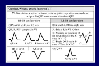 Ventricular Tachycardia Vs Supraventricular Tachycardia