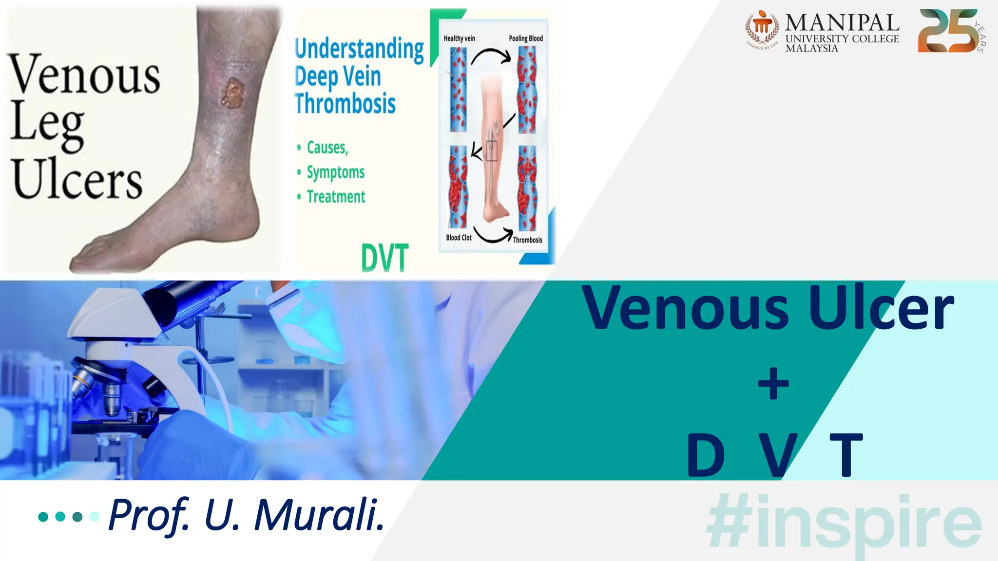 Venous Ulcer and Deep Vein Thrombosis - Causes & Management | PDF