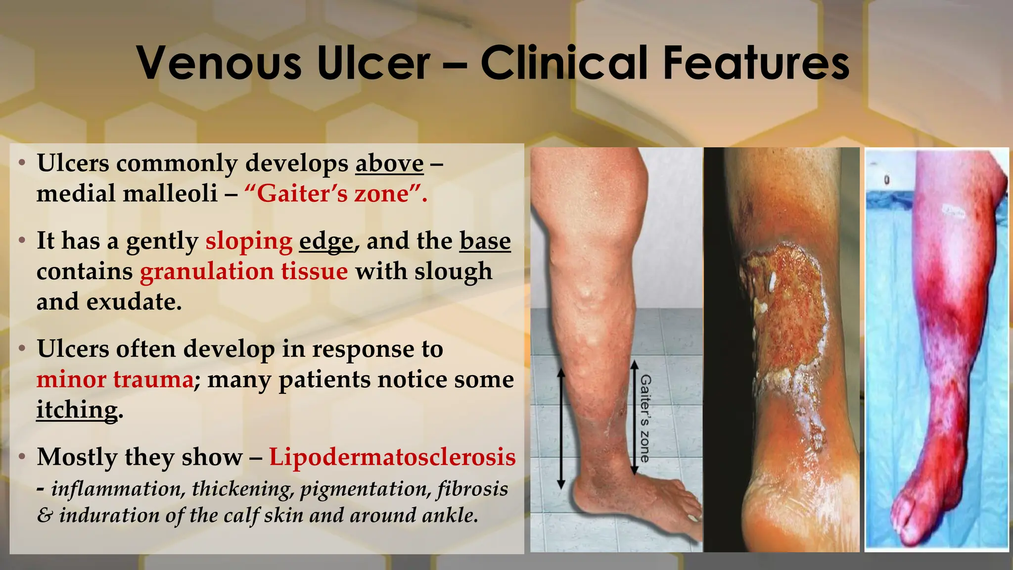 Venous Ulcer and Deep Vein Thrombosis - Causes & Management | PDF
