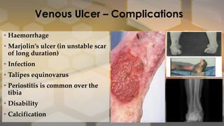 Venous Ulcer and Deep Vein Thrombosis - Causes & Management | PDF