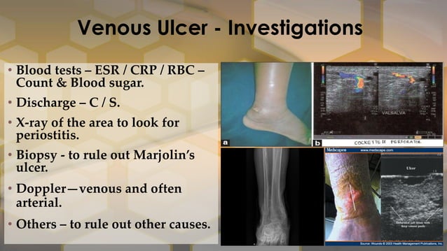 Venous Ulcer and Deep Vein Thrombosis - Causes & Management | PDF ...