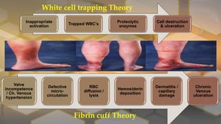 Venous Ulcer and Deep Vein Thrombosis - Causes & Management | PDF