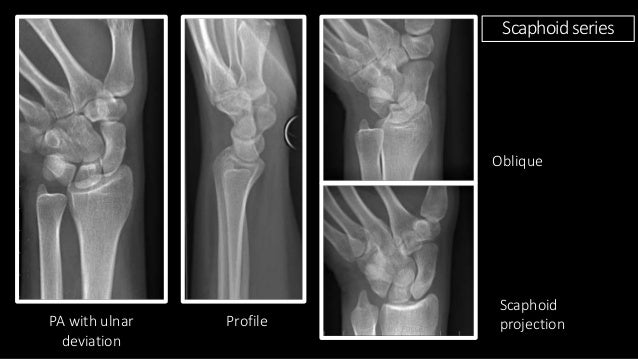 Scaphoid fractures in children