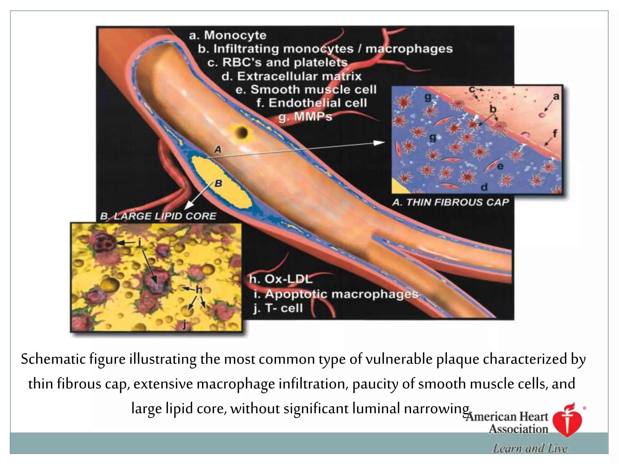 Vulnerable plaque | PPTX