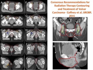 vulva.pptx radiation oncology ppt radiation | PPTX