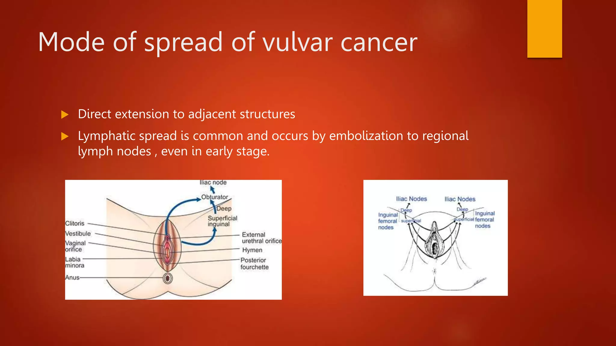 vulval cancer 🍁 | PPTX