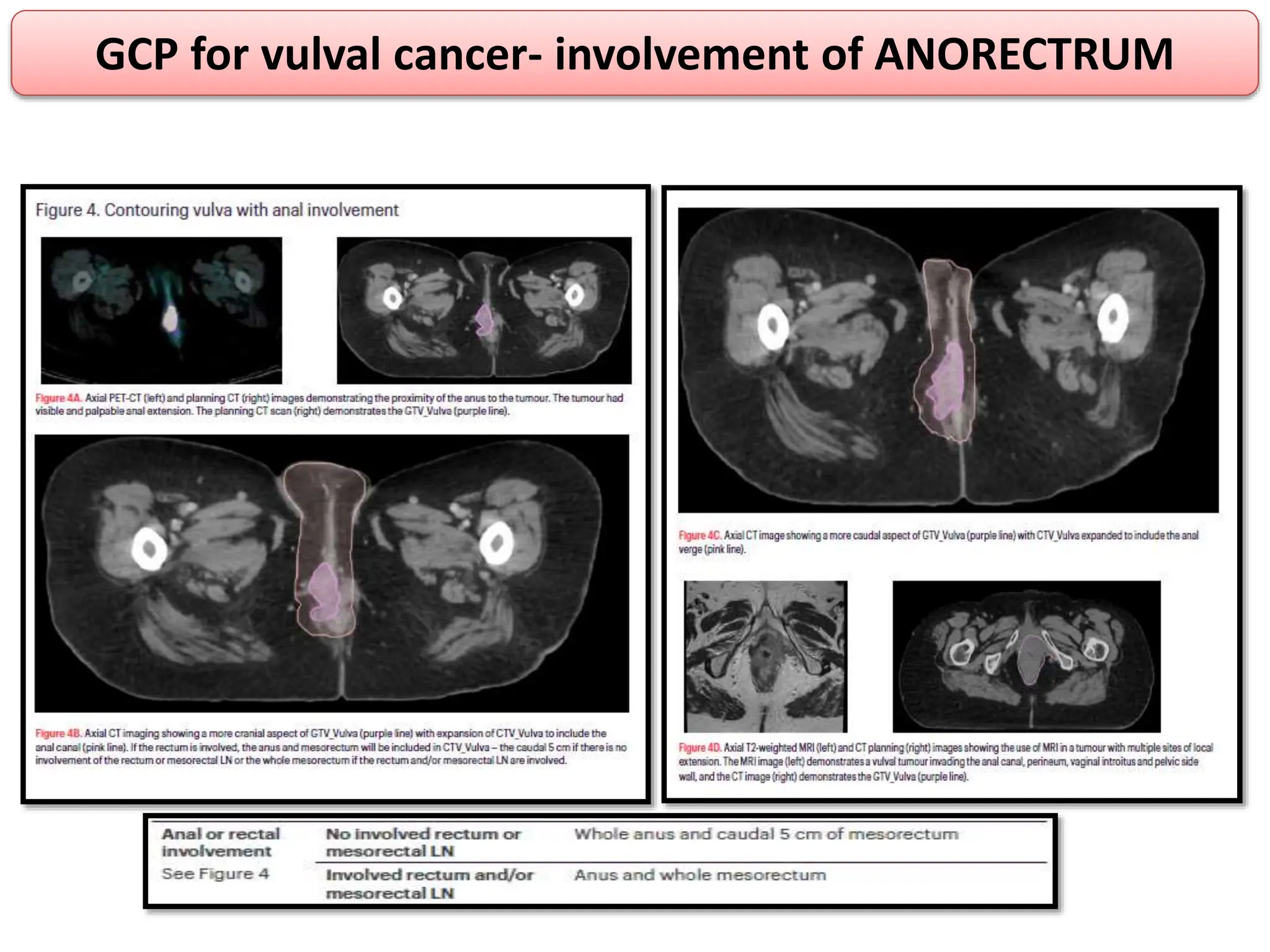 TARGET DELINEATION IN VULVAL CANCER BY DR KANHU | PPTX